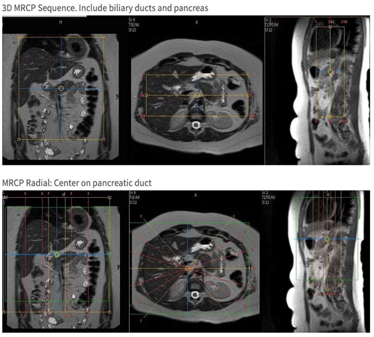 MR Pancreas W/WO with MRCP BODY Protocol | OHSU